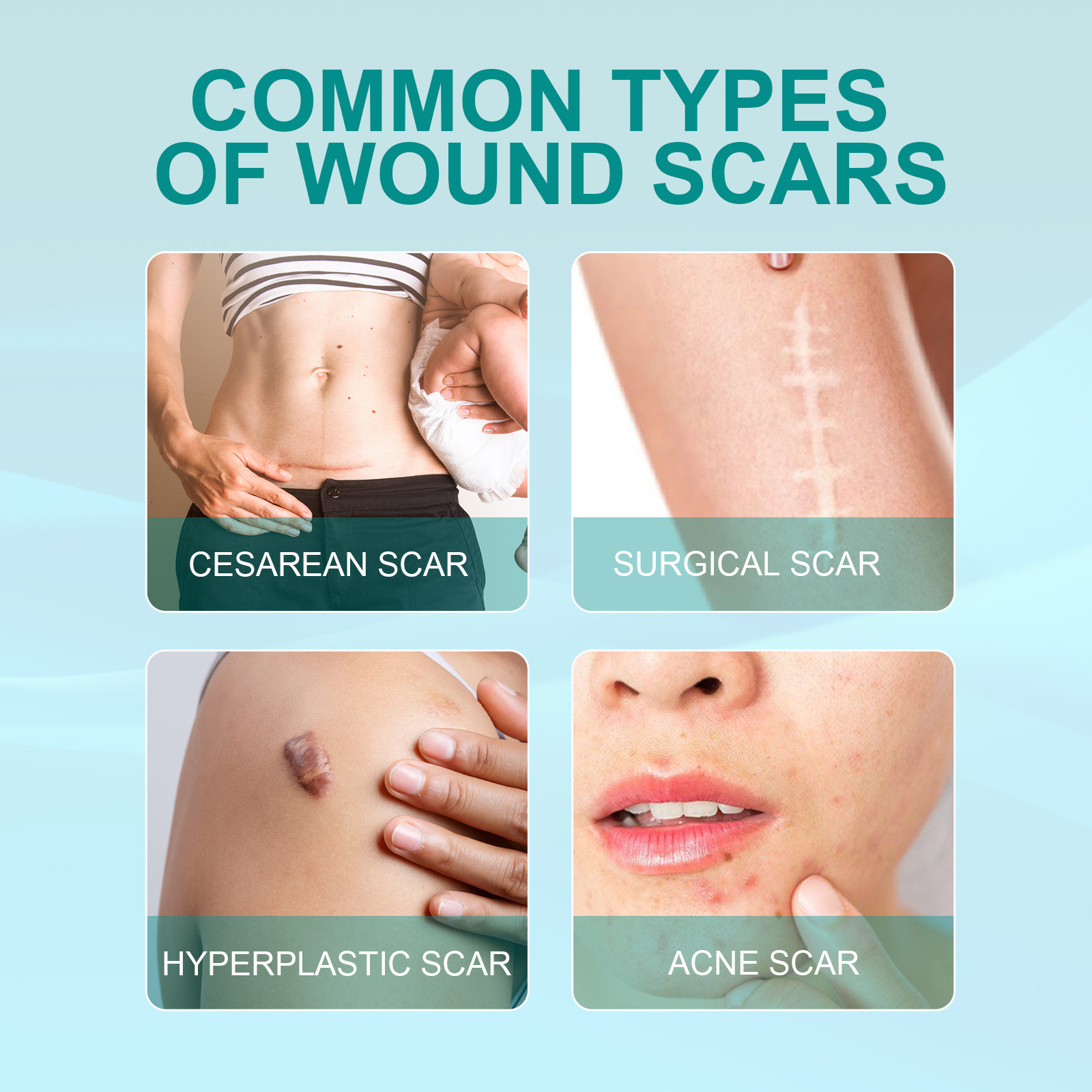 ADVANCED SCAR SPRAY FOR ALL TYPES OF SCARS – FOR EXAMPLE ACNE SCARS ... ADVANCED SCAR SPRAY FOR ALL TYPES OF SCARS – FOR EXAMPLE ACNE SCARS ...